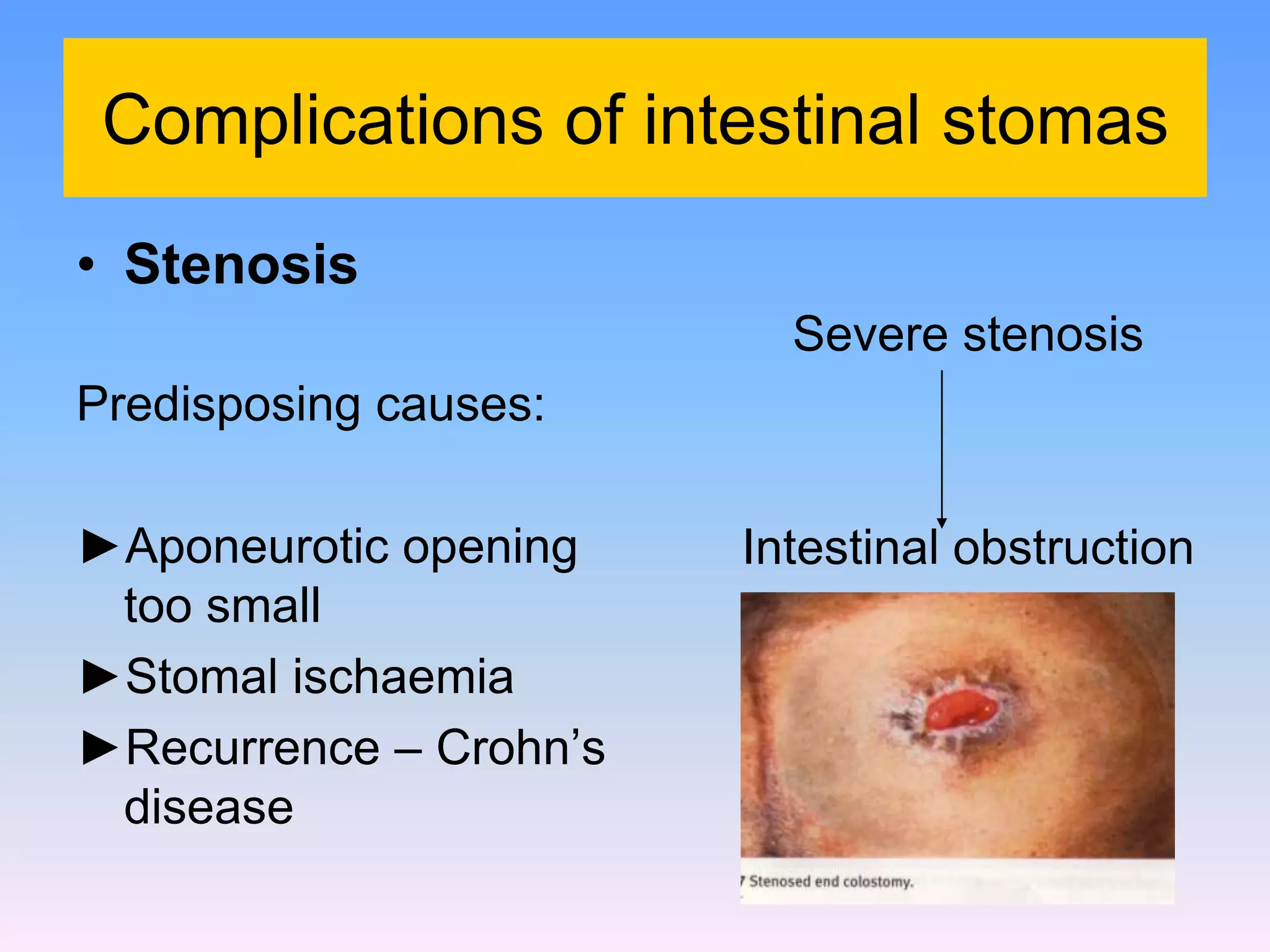Intestinal stomas | PDF