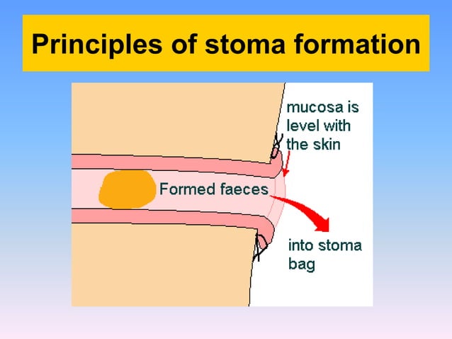 Intestinal stomas | PDF
