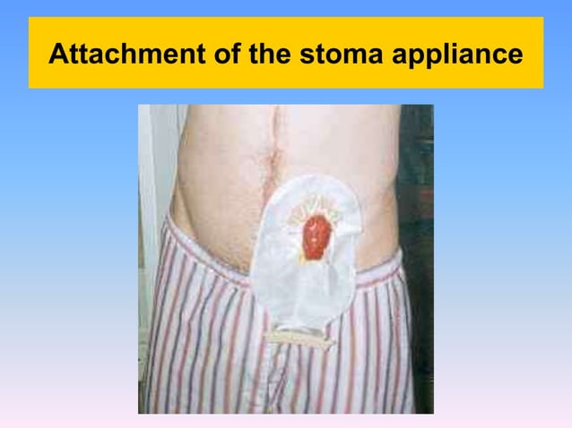 Intestinal stomas | PDF