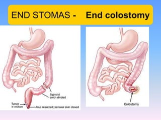 Divided Colostomy