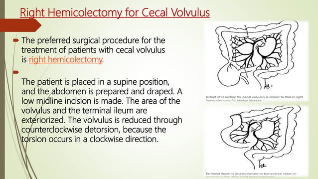 Intestinal ( Bowel) strangulation | PPTX | Digestive Disorders ...