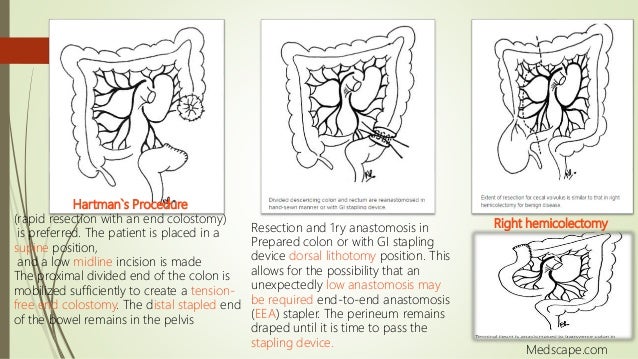 Intestinal ( Bowel) strangulation
