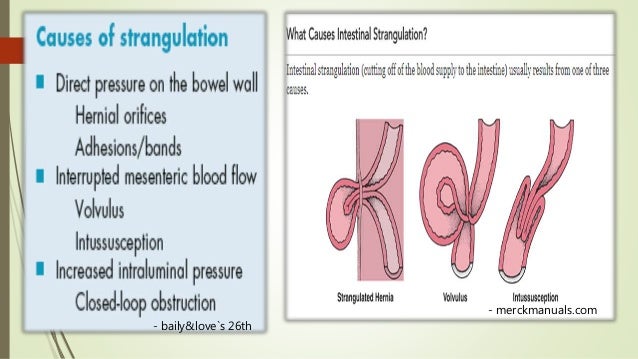 Intestinal ( Bowel) strangulation