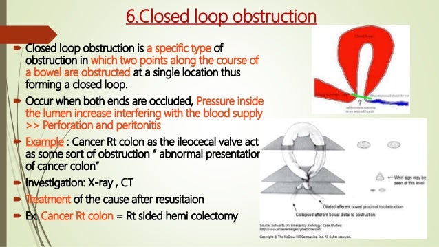 Intestinal ( Bowel) strangulation