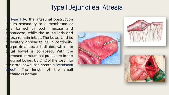New born intestinal obstraction surgery.pptx