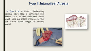 New born intestinal obstraction surgery.pptx