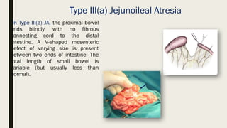 New born intestinal obstraction surgery.pptx
