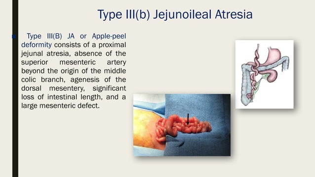 New born intestinal obstraction surgery.pptx