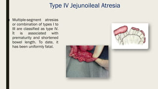 New born intestinal obstraction surgery.pptx