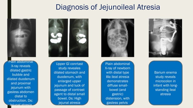 New born intestinal obstraction surgery.pptx