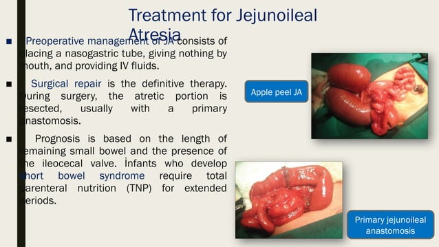 New born intestinal obstraction surgery.pptx