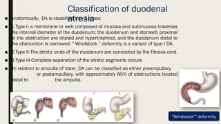 New born intestinal obstraction surgery.pptx