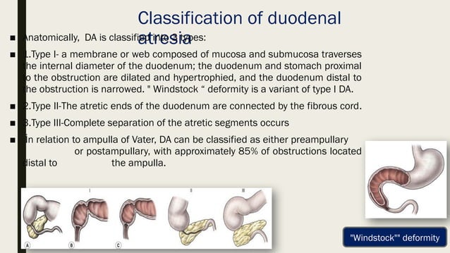 New born intestinal obstraction surgery.pptx