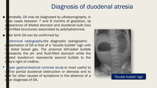 New born intestinal obstraction surgery.pptx