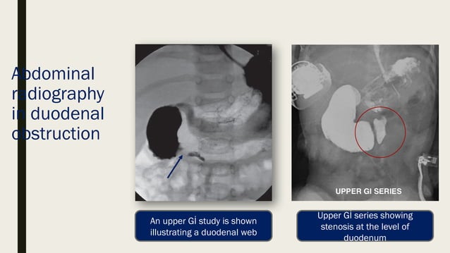 New born intestinal obstraction surgery.pptx