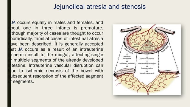 New born intestinal obstraction surgery.pptx