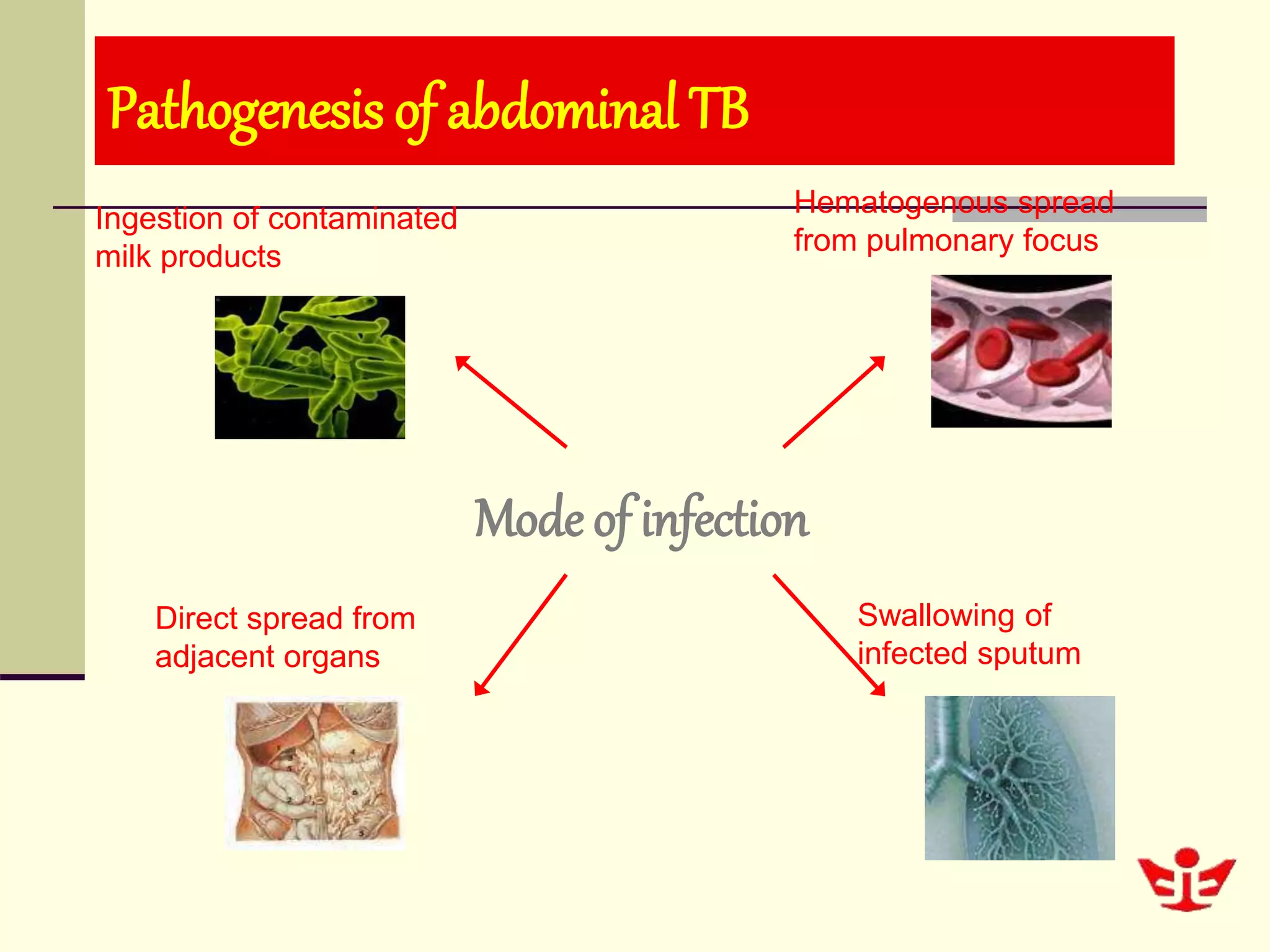 Intestinal tuberculosis | PPT
