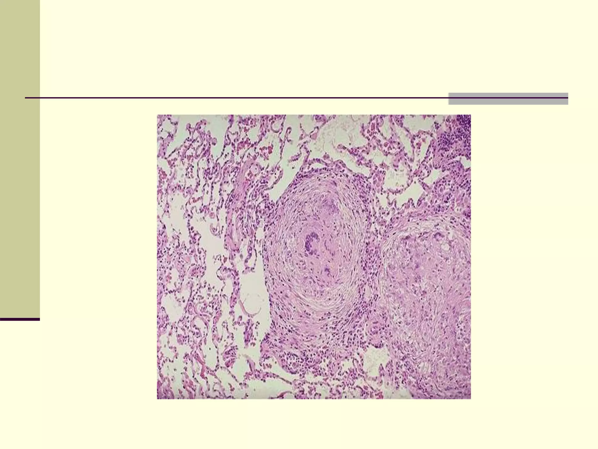 Intestinal tuberculosis | PPT