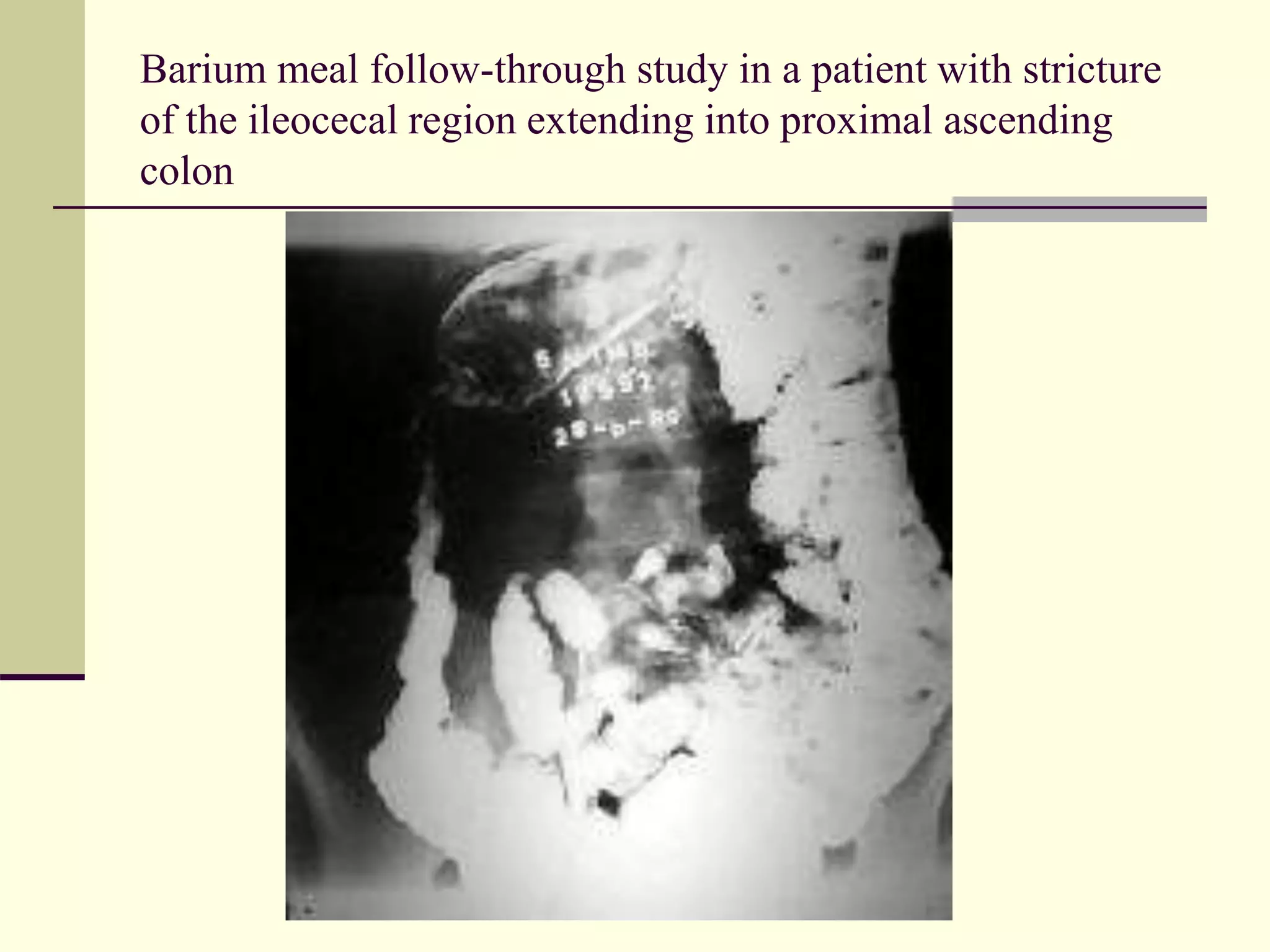Intestinal tuberculosis | PPT