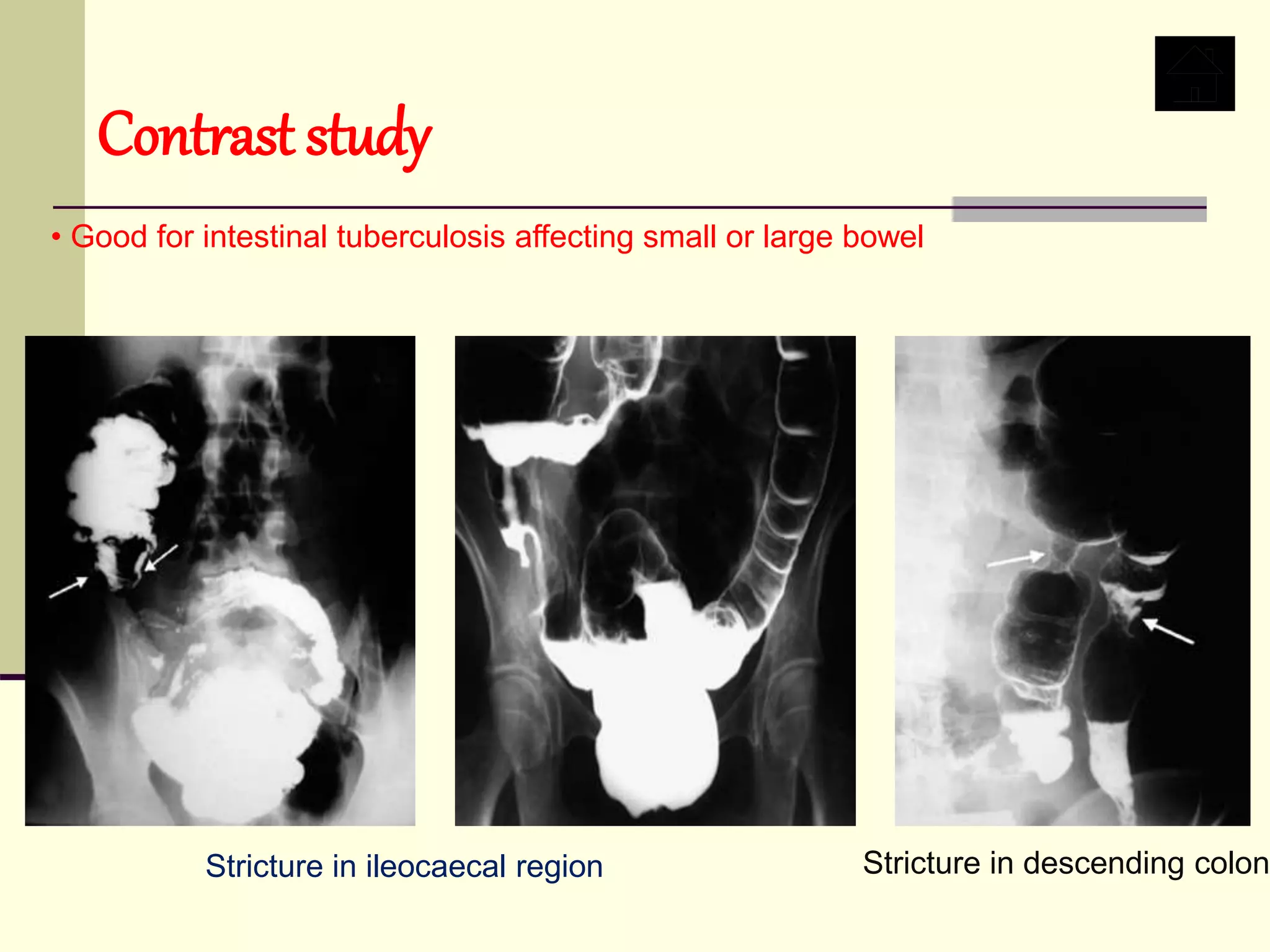 Intestinal tuberculosis | PPT