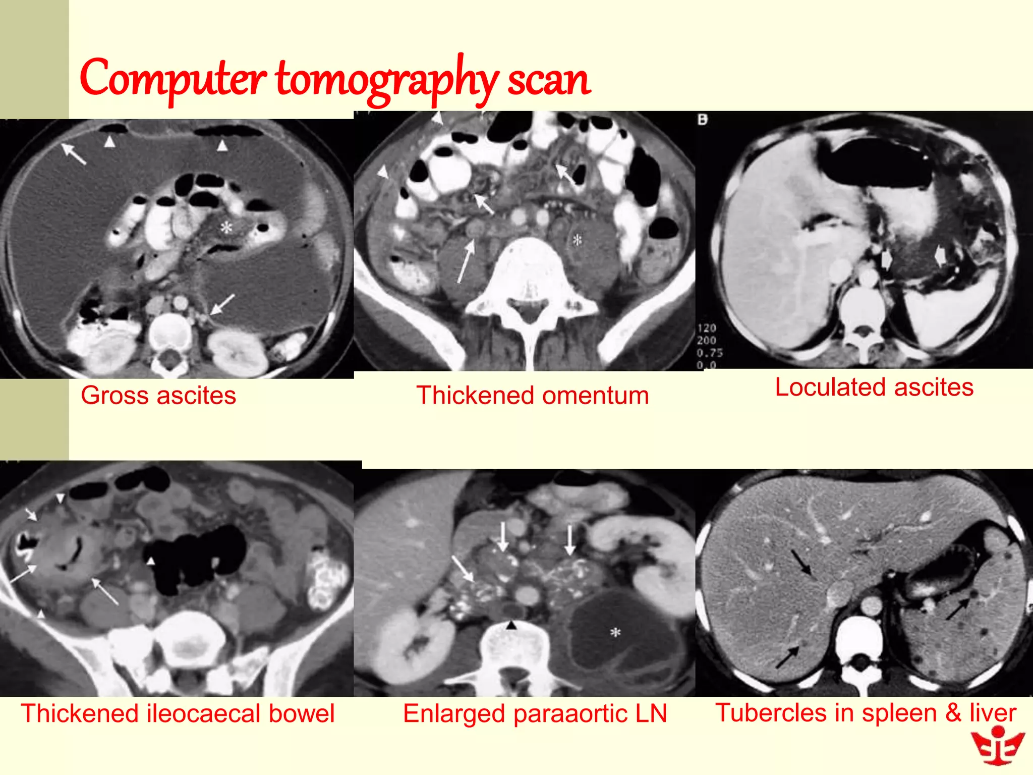 Intestinal tuberculosis | PPT