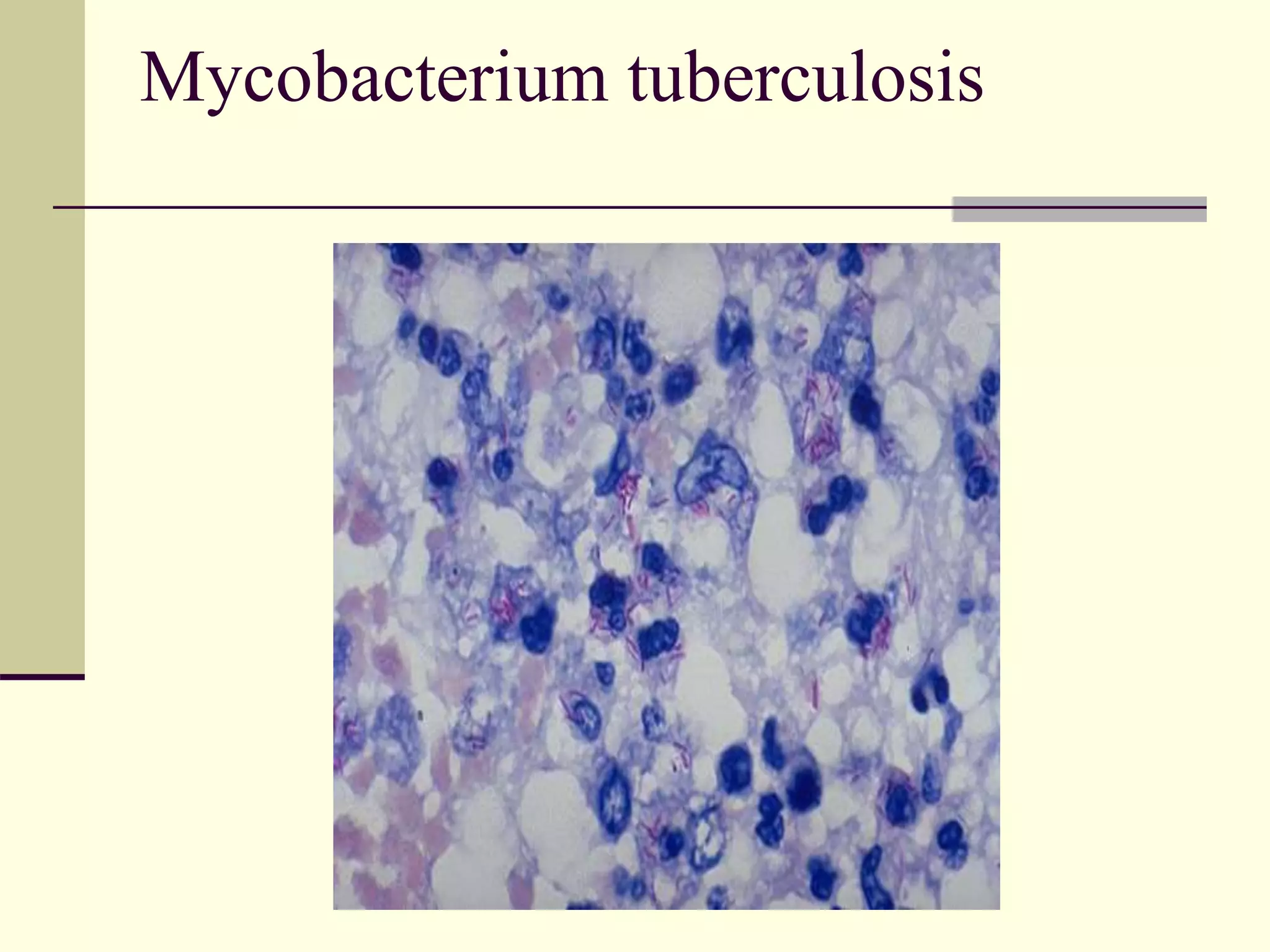 Intestinal tuberculosis | PPT