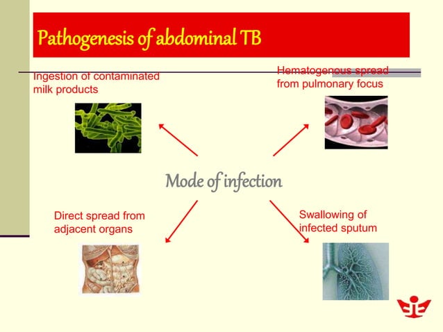 Intestinal tuberculosis | PPT