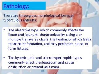 presentation for Intestinal tuberculosis.pptx