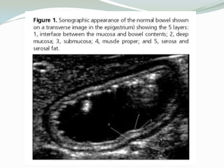 Intestinal Ultrasound | PPTX