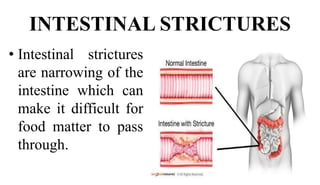 INTESTINE OBSTRUCTION.pptx