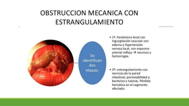 Obstrucción de intestino delgado