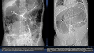 INTESTINO GRUESO.pptx