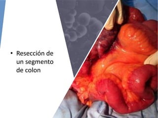 INTESTINO GRUESO CIRUGIAS CON TECNICAS QUIRURGICAS | PDF