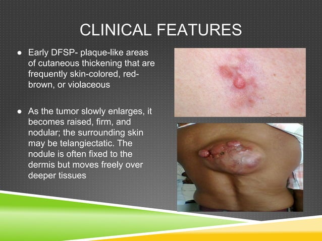 In the Flesh- dermatofibrosarcoma protuberans (dfsp) | PDF