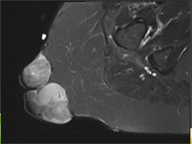 In the Flesh- dermatofibrosarcoma protuberans (dfsp)