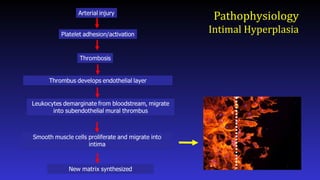 Intimal hyperplasia | PPT