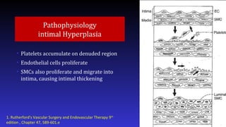 Intimal hyperplasia | PPT