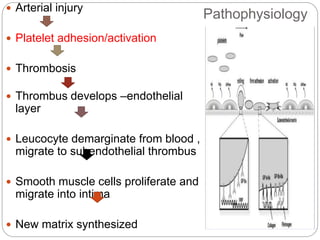 Intimal hyperplasia | PPTX