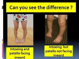 Intoeing | PPTX