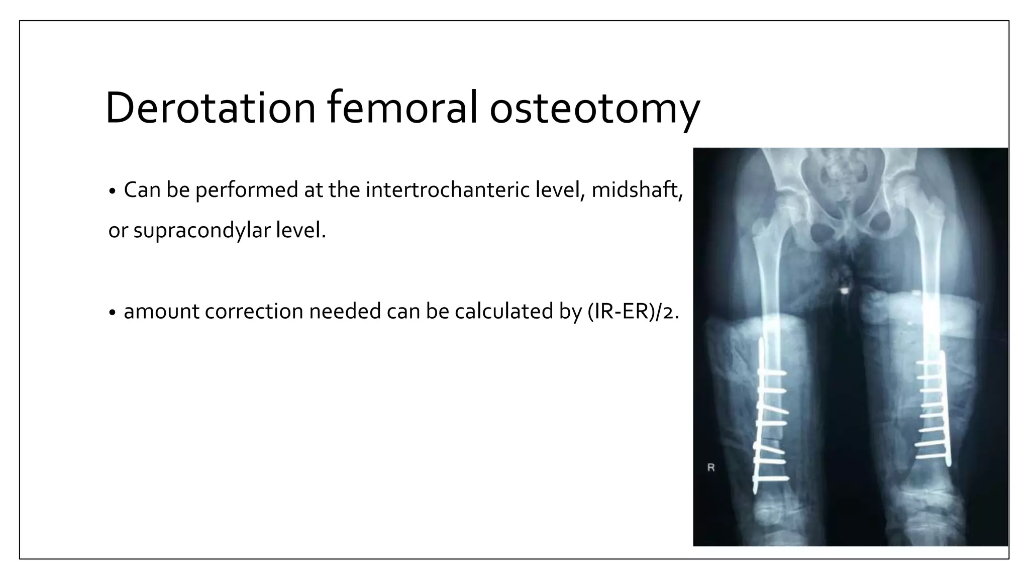 Intoeing gait | PPTX