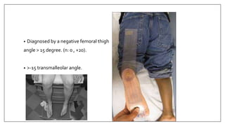 Intoeing gait | PPTX