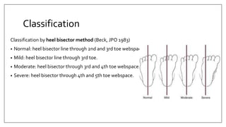 Intoeing gait | PPTX