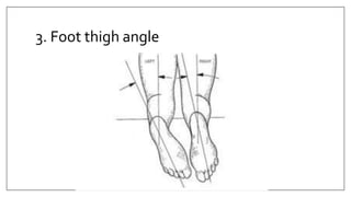 Intoeing gait | PPTX