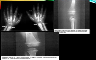 Intoxicacion por plomo | PPTX