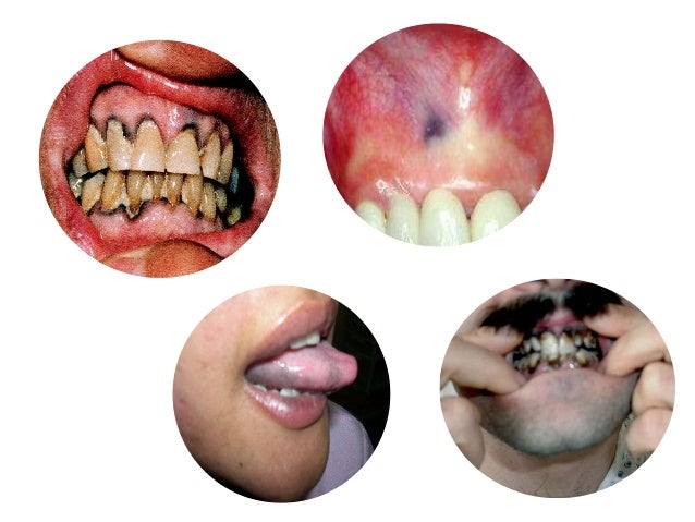 Intoxicacion por plomo