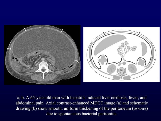 Intra-Abdominal infection the lect #.ppt | Digestive Disorders ...