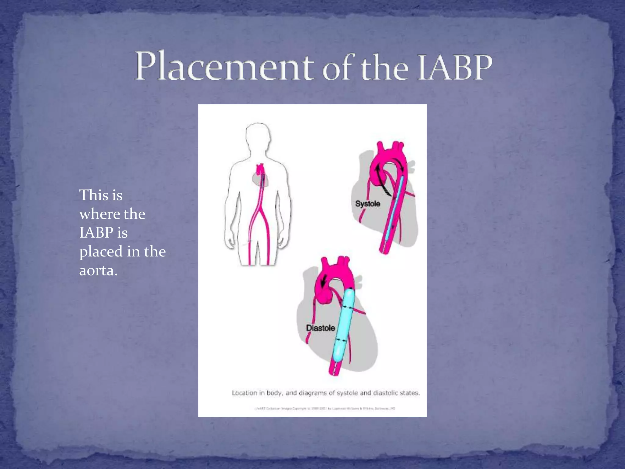 Intra aortic balloon pumps | PPTX