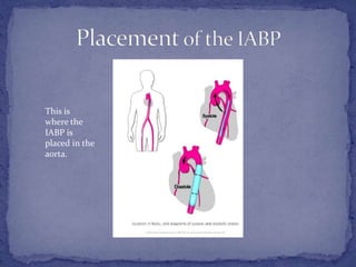 Intra aortic balloon pumps | PPTX