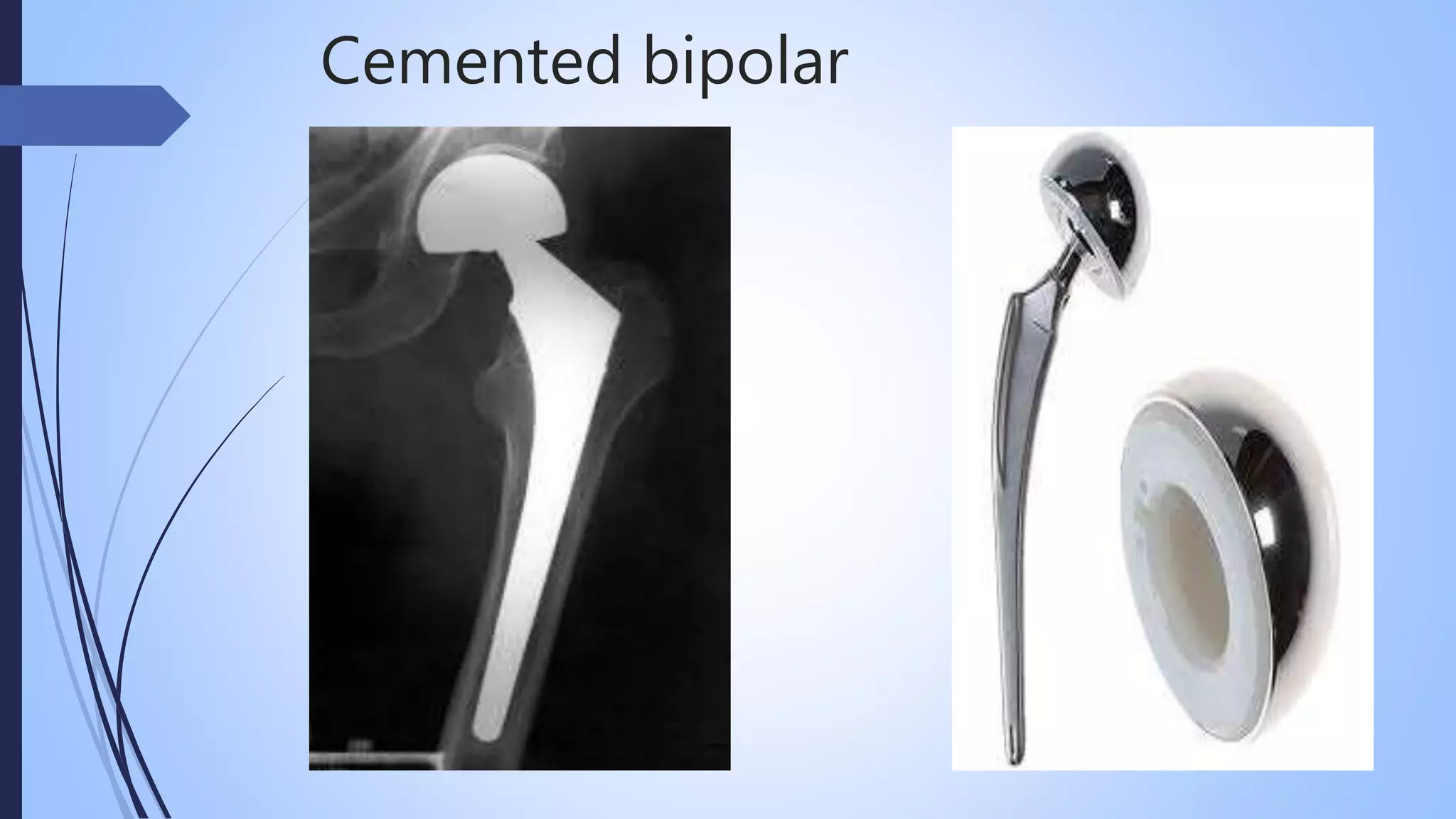 Intra capsular neck of femur fractures | PPTX