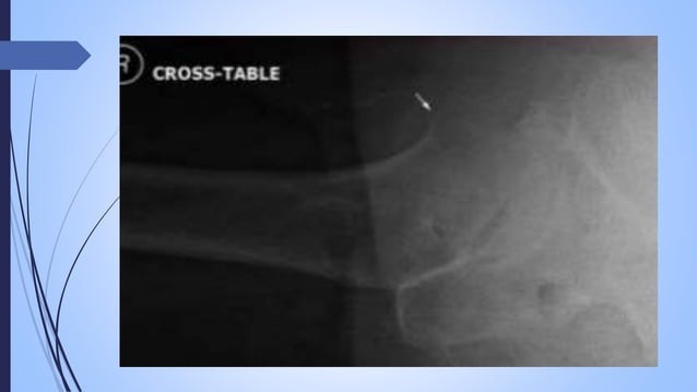 Intra capsular neck of femur fractures | PPTX